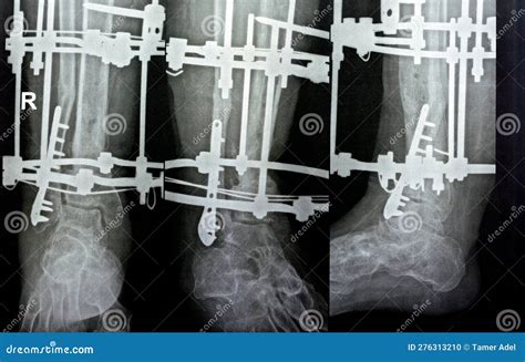 Distal Comminuted Fracture Fibula Managed By Plate And Screws Distal