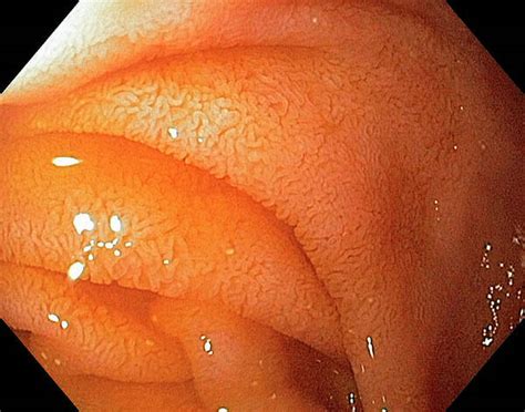 Normal Duodenum Art Print By Science Photo Library Science Photo Gallery Normal Duodenum Art Print By Science Photo Library Science Photo Gallery