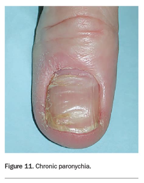 Evaluation And Management Of Nail Diseases Medicine Today