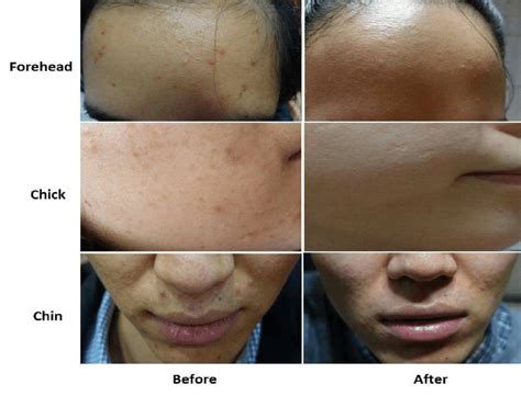 Staphylococcus Epidermidis Face