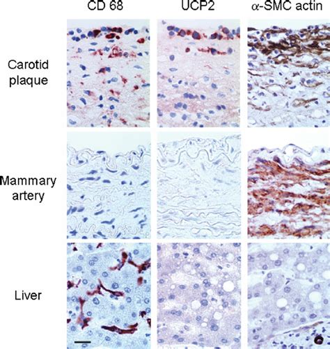 Ucp2 Is Present In The Subendothelial Layer Of Human Atherosclerotic