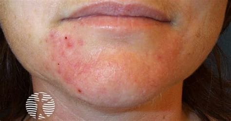 Perioral Dermatitis Image