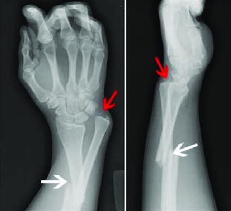 Ap And Lateral X Rays Of The Right Forearm And Wrist Note The Fracture