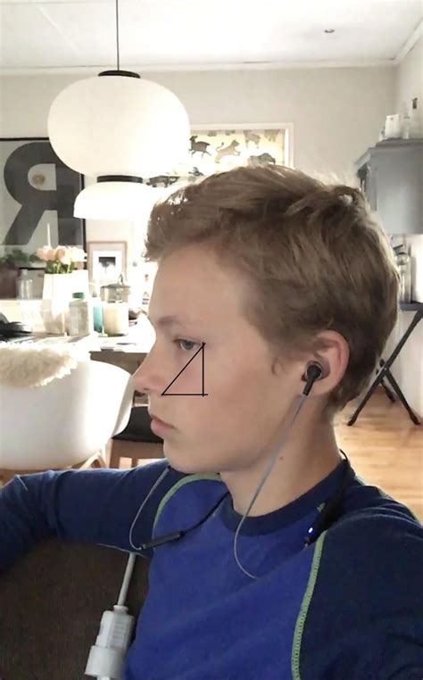 Premolar Extraction Retraction Victim What Should I Do R Jawsurgery