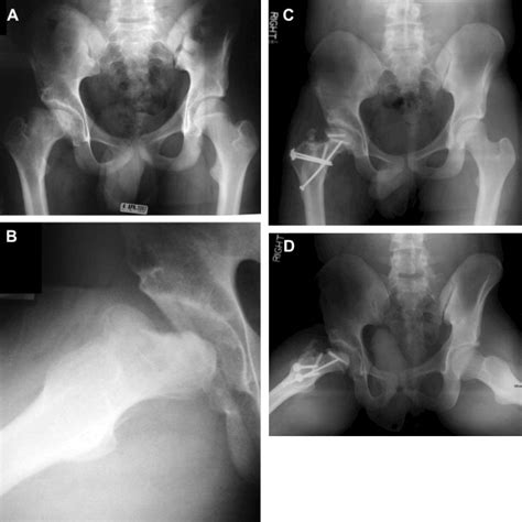The Treatment Of Femoral Head Deformity And Coxa Magna By The Ganz