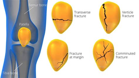 9 Easy Knee Cap Fracture Exercise And Physiotherapy Protocol