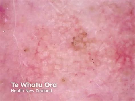 Rosettes In Dermoscopy