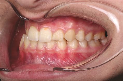 Brava A Novel Orthodontic System Resolves A Functional Shift
