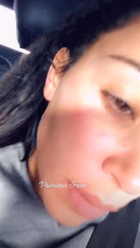 Kim Kardashian Documents Psoriasis In Morning Selfie