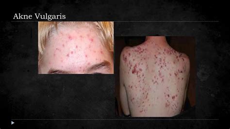 Abses Folikel Rambut Dan Kelenjar Sebasea Unizar Pptx