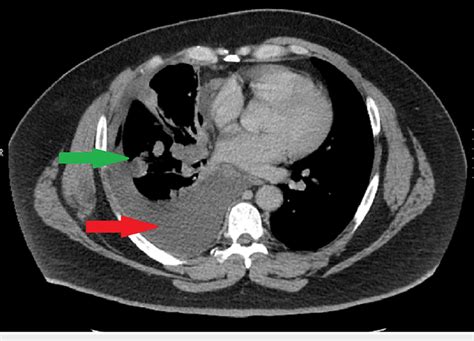 Ct Scan Showing Right Sided Lung Mass Green Arrow And Pleural