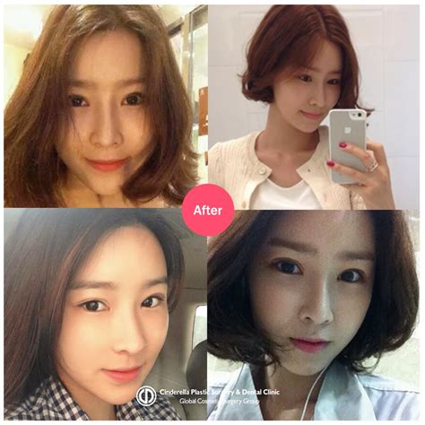 Cinderella Plastic Surgery Cinderella Plastic Surgery Before And After Photos Two Jaw Surgery