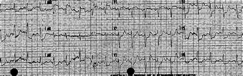 Dr Smiths Ecg Blog Ste In Avr And Diffuse St Depression It Can Be