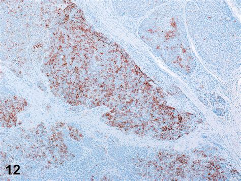 Biphasic Malignant Testicular Sex Cord Stromal Tumor In A Cotton Top