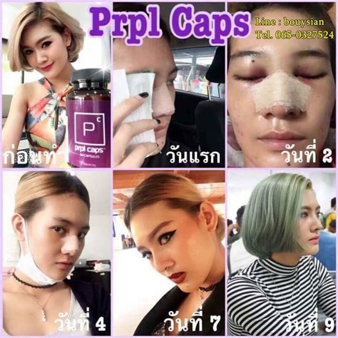 รีวิวทำจมูกทาน Prpl Caps ผลิตภัณฑ์ อาหารเสริม 18