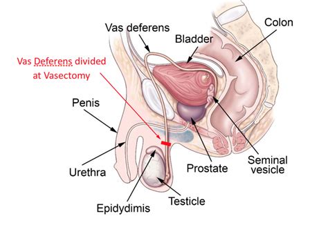 Vasectomy Procedure Dr Krumholtzs Skilled Microsurgery Gives Men