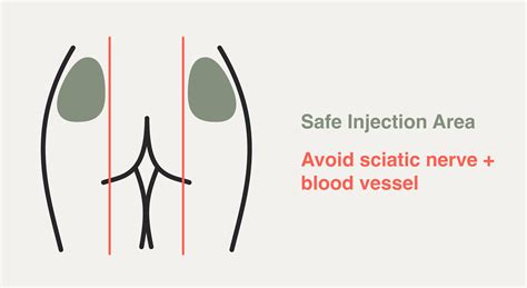 Can You Ice An Injection Site At Chelsea Elyard Blog