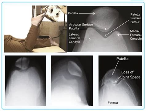 Special X Ray Views In Orthopedics For Neet Pg Prepladder