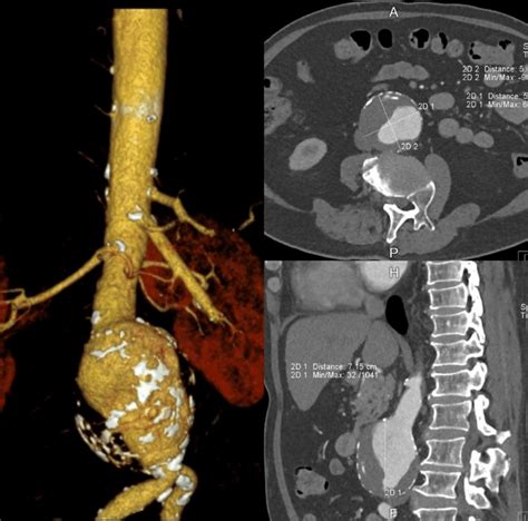 Computed Tomography Abdominal Aortogram Measured A 715 Cm × 567 Cm ×
