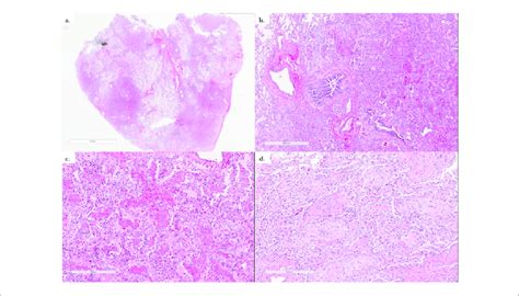 Histopathology Of Patient 1 A Low Magnification Showing Patchy