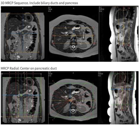 Mr Pancreas W Wo With Mrcp Body Protocol Ohsu