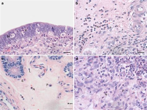 Infiltration Of Immune Cells In Subepithelial Layer Of The Endometrium