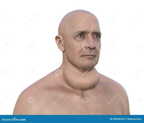 A Man With Enlarged Thyroid Gland 3d Illustration Stock Illustration