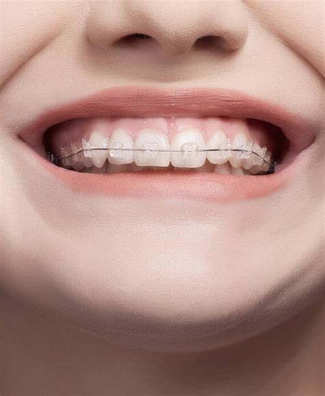 Clear Braces Rocky Point Orthodontics Clear Braces Long Island