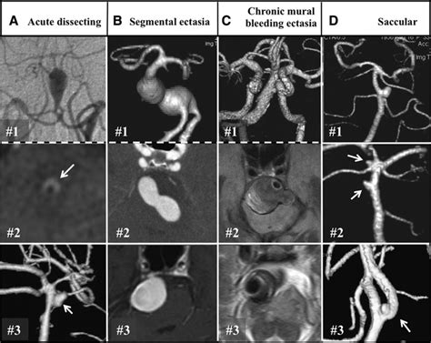 Natural History And Management Of Basilar Trunk Artery Aneurysms Stroke