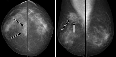 Finding Early Invasive Breast Cancers A Practical Approach Radiology