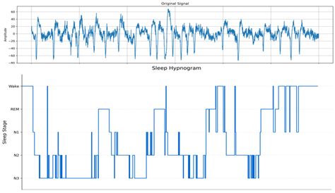 Time Series Representation Feature Refinement With A Learnable Masking