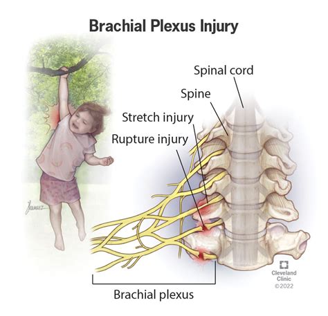 Brachial Plexus Injury Symptoms