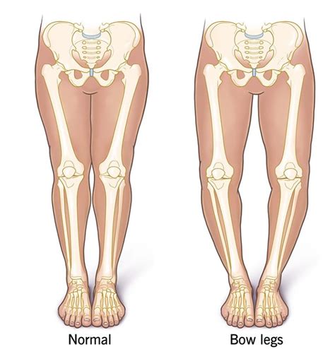 Bow Leg Correction Surgery Genu Varum In India Dr Divya