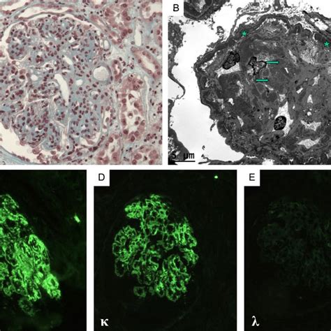 Proliferative Glomerulonephritis With Non Randall Type Non Organized