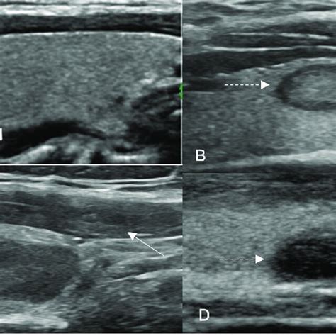Solid Nodule Tr3tr4 Distribution Regarding Echogenicity And Download Scientific Diagram
