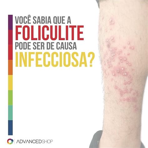 🧴🧴você Sabia Que A Foliculite Pode Ser Causada Por Infecção Bacteriana 🧴🧴a Foliculite é Uma