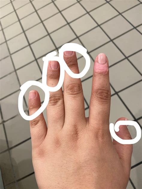 Uv Hyperpigmentation Rnailtechs