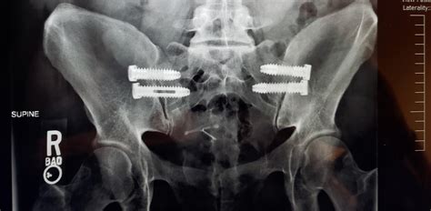 Bilateral Sacroiliac Joint Fusion Surgery R Xrayporn