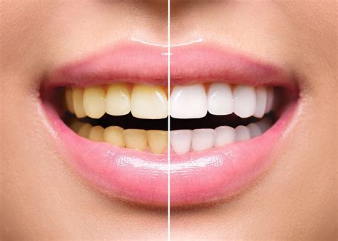 Teeth Whitening Mandurah Platinum Smile Dentist Mandurah