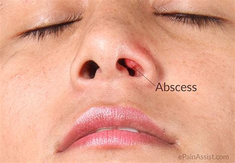 Nasal Vestibulitis Treatment Causes Signs Symptoms Risk Factors