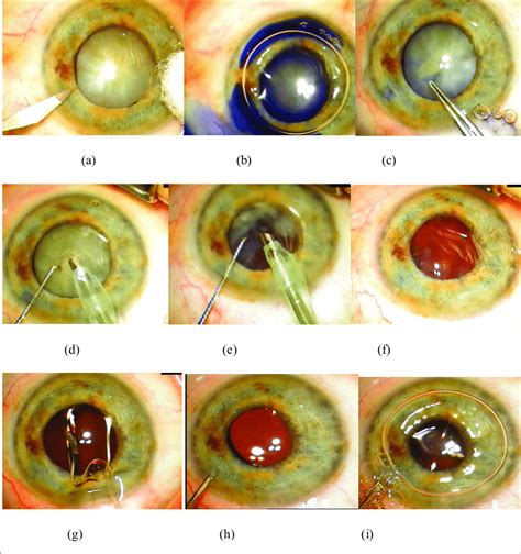 Operational Course Of Phacoemulsification With The Installation Of An