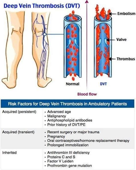 ‏deep Vein Thrombosis Dvt‏ ‏ Online Nremt Test Prep‏