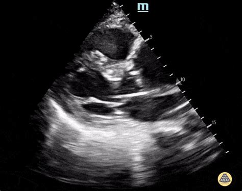 Thoracic Aortic Aneurysm Echocardiogram