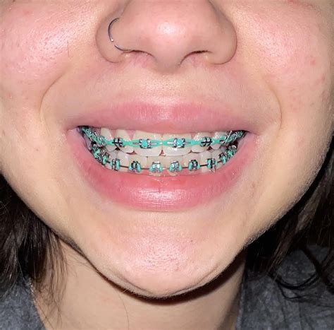 Midlinebite Opinions Rbraces