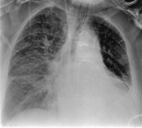 Pulmonary Edema Chest X Ray
