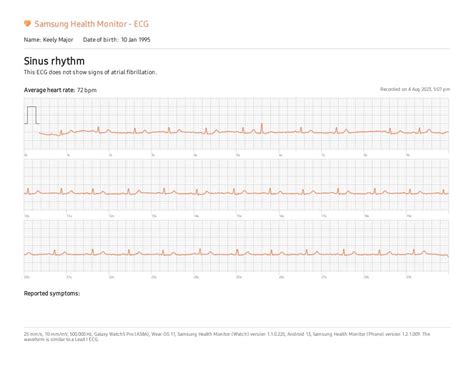 Sinus Pause Sinoatrial Block Rreadmyecg