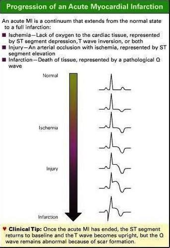 12 Lead Ekg Patterns Understanding Myocardial Infarction And Ischemia