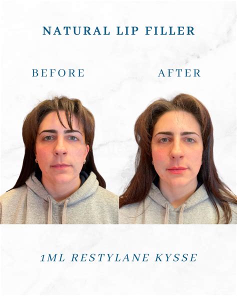 Lip Filler Restylane Kysse 29 Yo Caucasian Female Before And After Photos