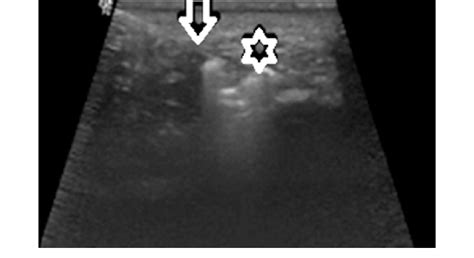 Ultrasound Image Showing Path Of The Echogenic Needle Open Arrow To