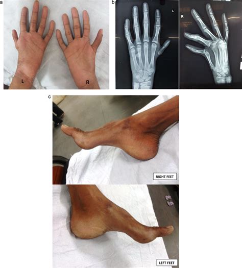 A Showing Hypoplastic Thenar Eminences And Hypoplastic Thumb Of Both Download Scientific